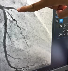 Coronary angiogram – Heart and Beyond